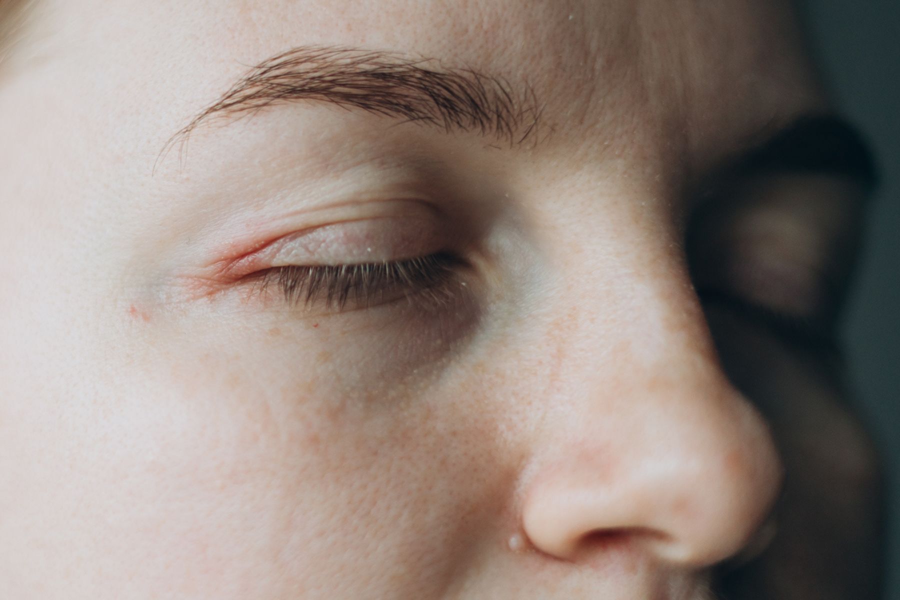 Congiuntivite e blefarite: sintomi e rimedi - Humanitas Salute